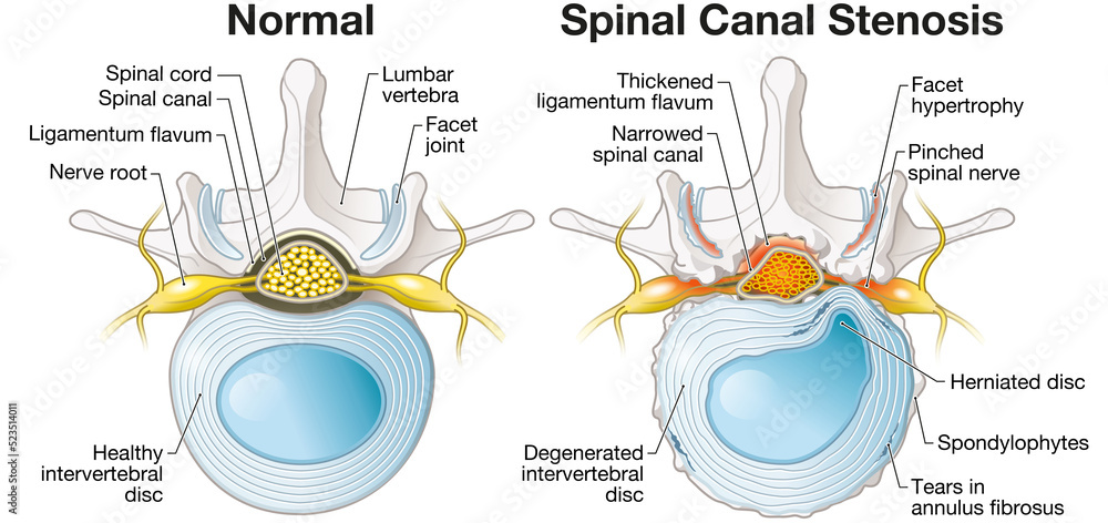 Spinal Canal Stenosis. Lumbar vertebra with intervertebral disc and ...