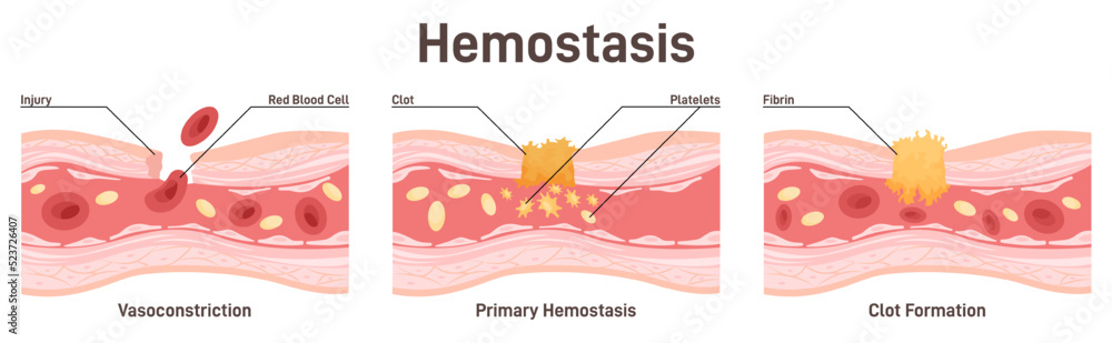 Hemostasis. Wound healing process stages, vasoconstriction and Stock ...