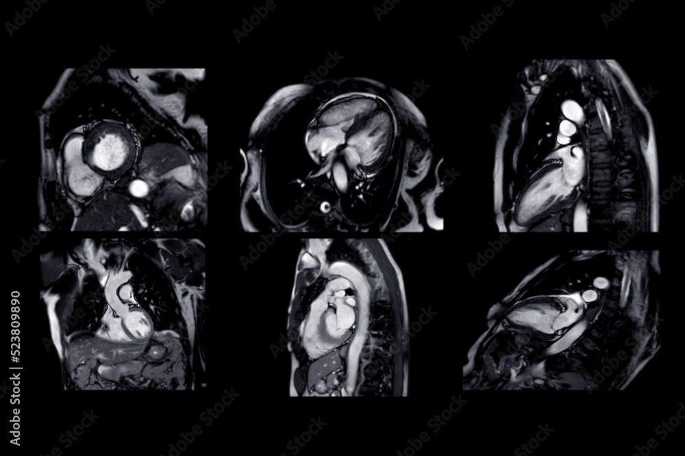 Collection of MRI heart or Cardiac MRI Stock Photo | Adobe Stock