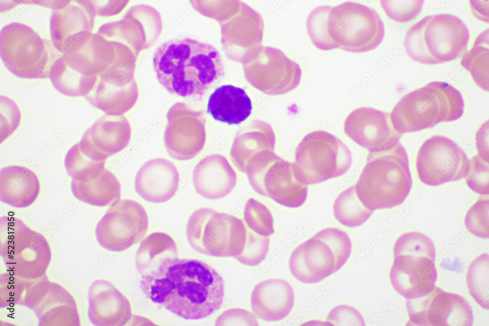 Picture of white blood cell, red blood cell and platelet in blood film ...