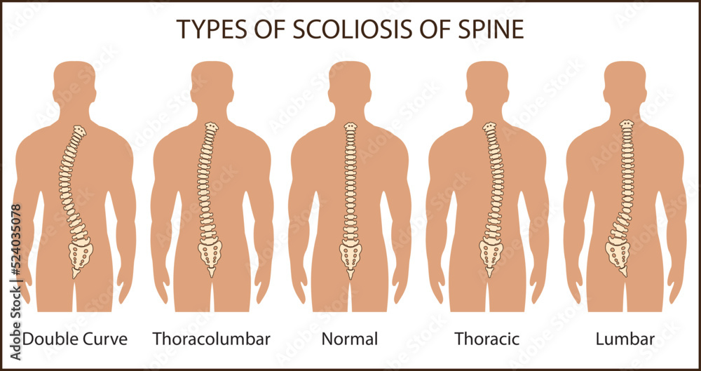 Medical poster demonstrating types of scoliosis on white background ...