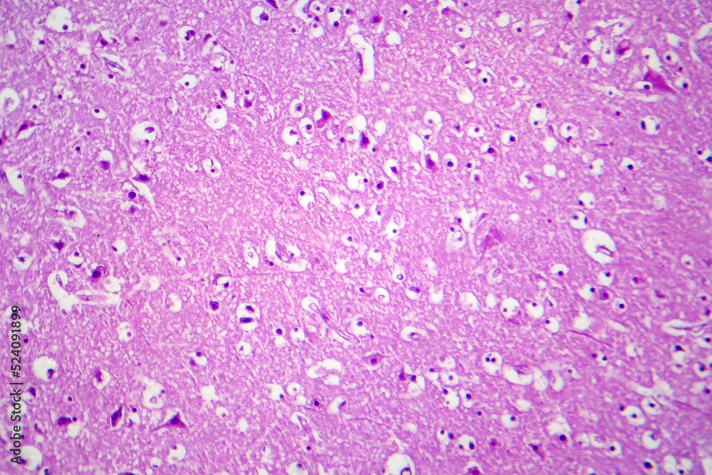 Histopathology of Japanese encephalitis, light micrograph Stock Photo ... Histopathology of Japanese encephalitis, light micrograph Stock Photo ...