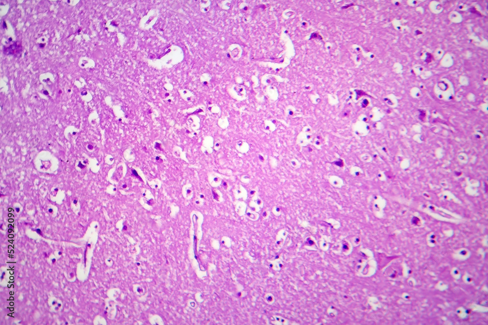 Histopathology of Japanese encephalitis, light micrograph Stock Photo ... Histopathology of Japanese encephalitis, light micrograph Stock Photo ...