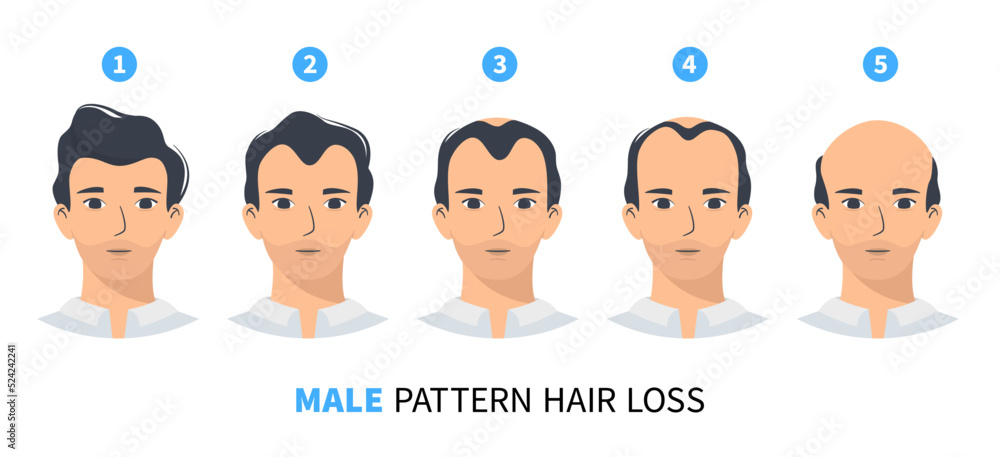 Hair Loss Stages Androgenetic Alopecia Male Pattern Steps Of Baldness Vector Infographic In A