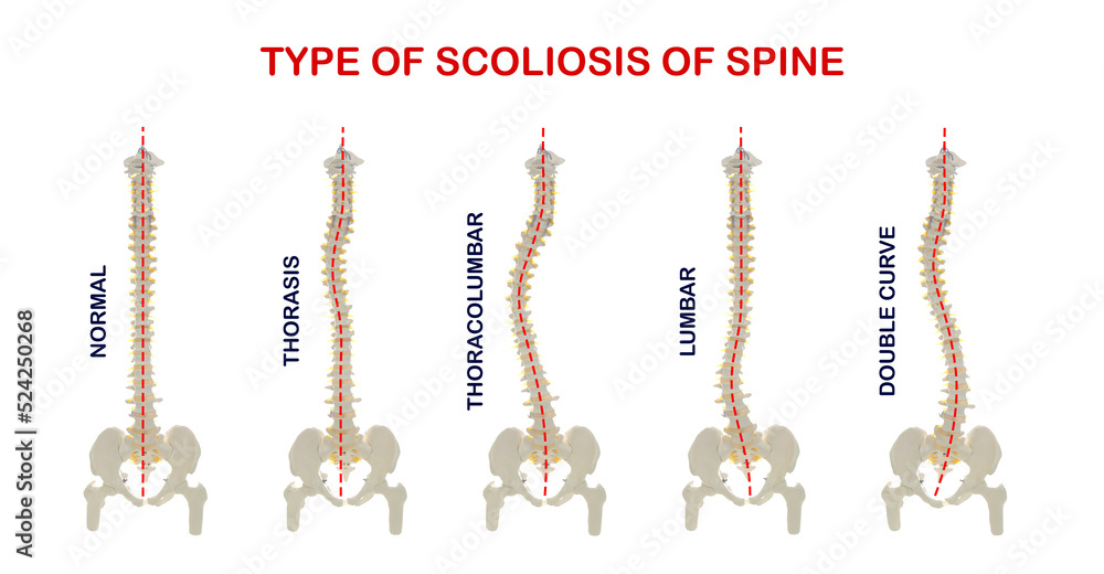 Medical poster demonstrating types of scoliosis on white background ...