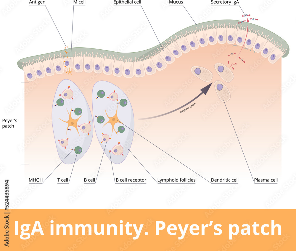 Vecteur Stock IgA immunity. Peyer’s patch. Lymphoid follicles of the ...