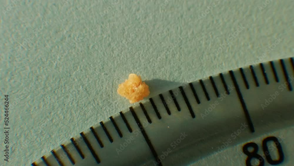 Oxalate stone extracted from a human, measure the size of the stone ...