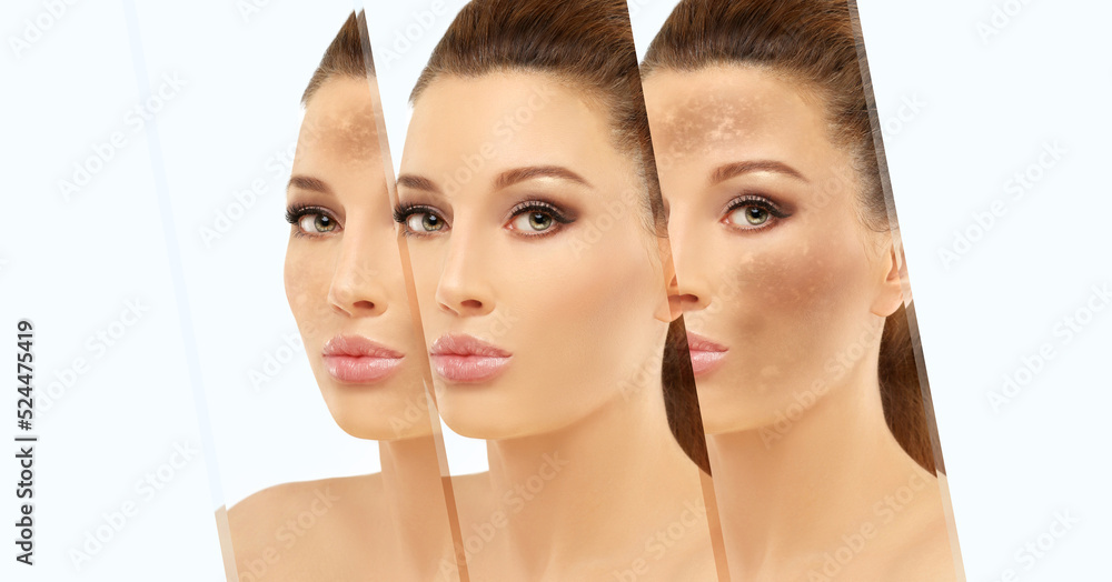 Dark spots, freckles,hyperpigmentation(melasma or chloasma),concept ...