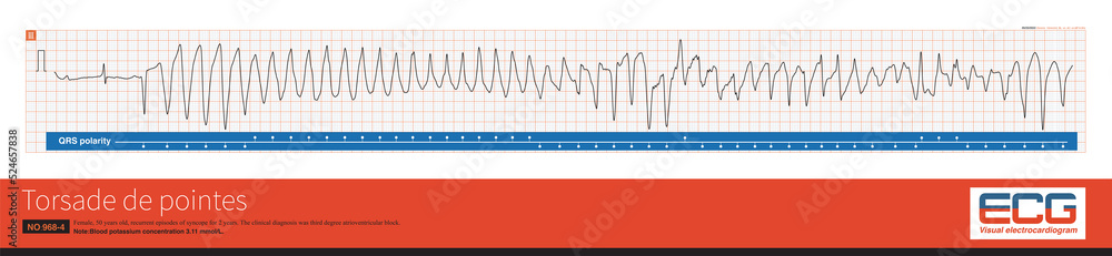 Torsade de pointes refers to the pleomorphic ventricular tachycardia ... Torsade de pointes refers to the pleomorphic ventricular tachycardia ...