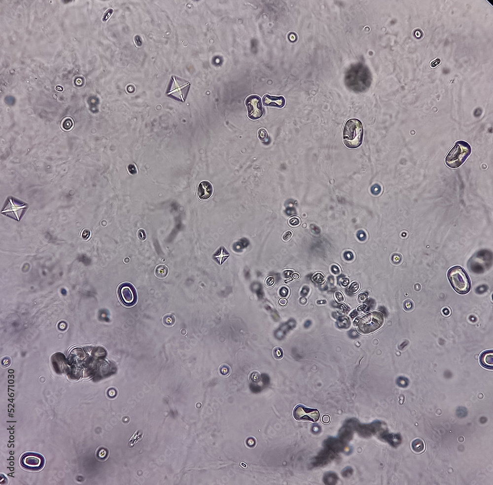 Microscopic image showing Calcium oxalate (monohydrate and dihydrate ...