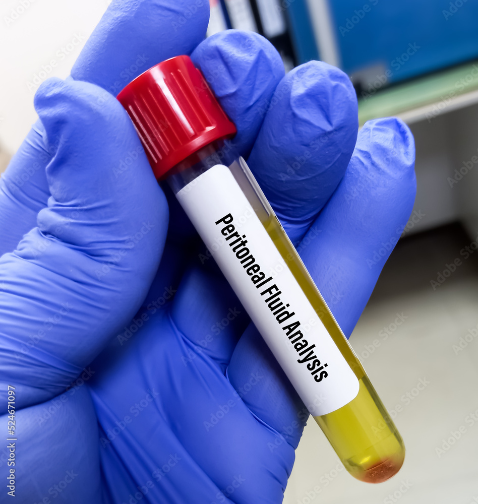 Biochemist or medical technologist hold Peritoneal fluid analysis ...