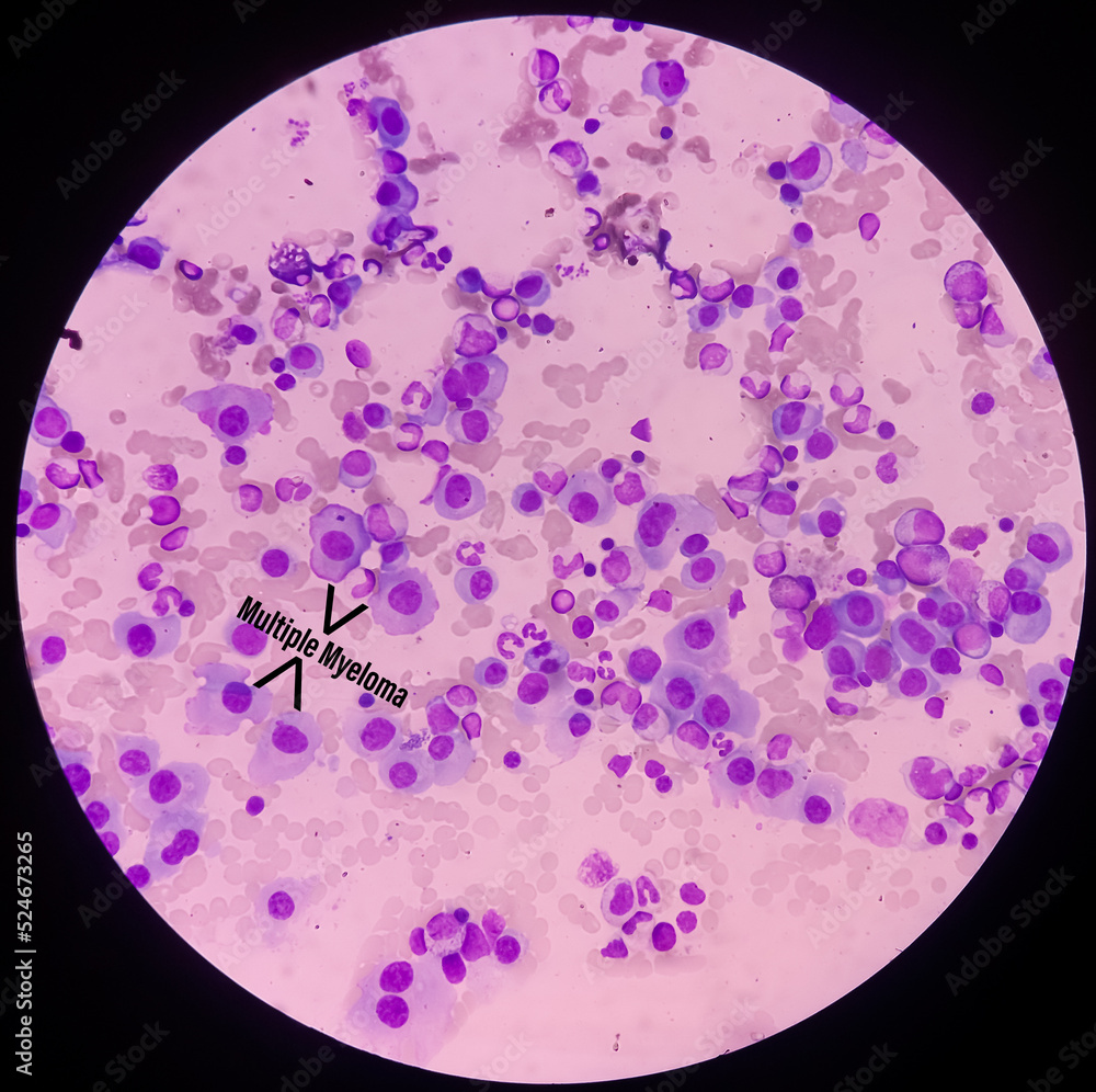 Microscopic image of bone marrow. Plasma cell dyscrasia or Multiple ...