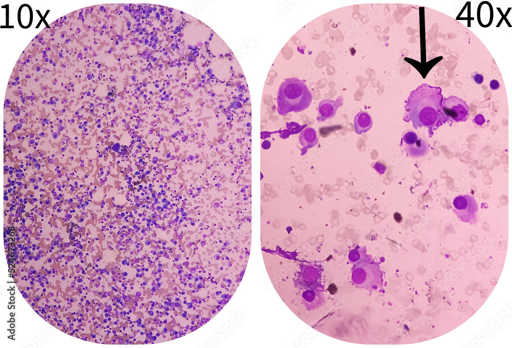 Microscopic image of bone marrow. Plasma cell dyscrasia or Multiple ...