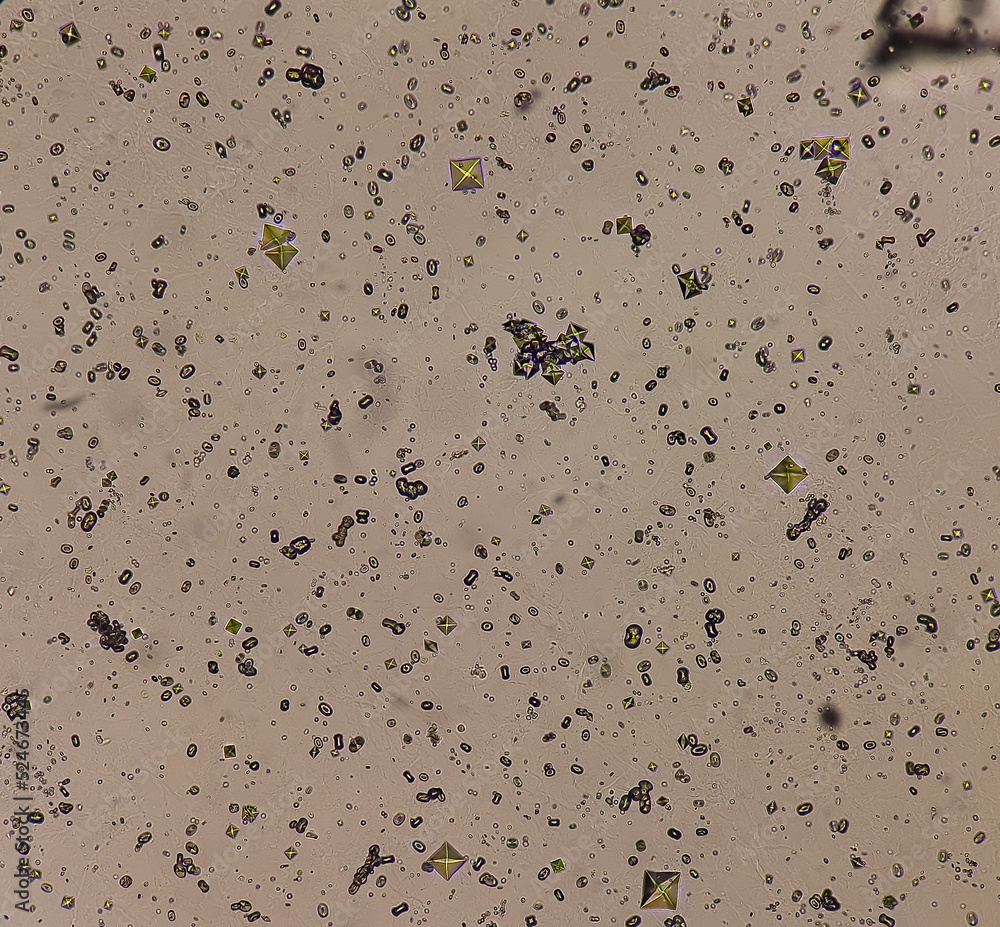 Microscopic image showing Calcium oxalate (monohydrate and dihydrate ...