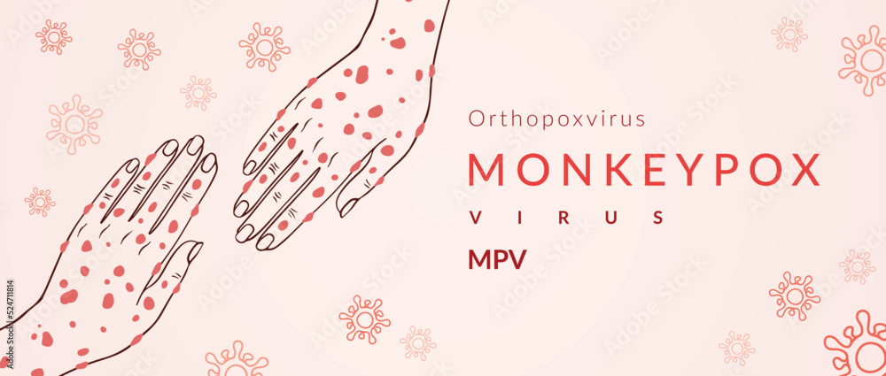 Monkeypox virus banner for awareness and alert against disease spread ...