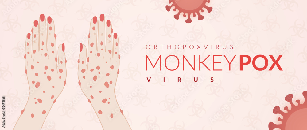 Vecteur Stock Monkeypox virus banner for awareness and alert against ...