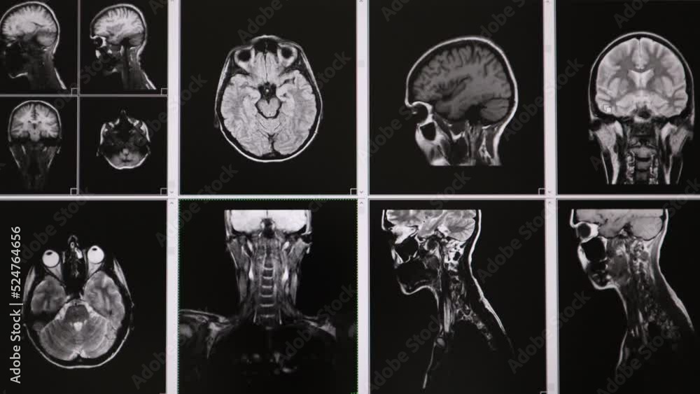 Tomography. MRI scans of the brain. Medical diagnostic examination for ...