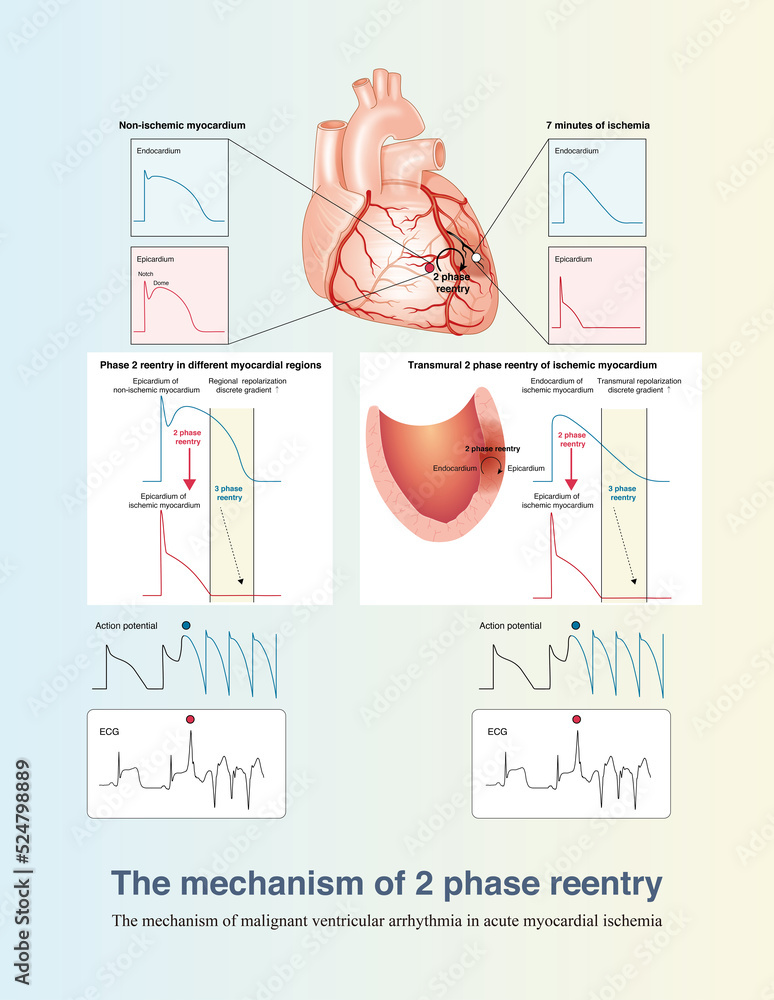 In the early stage of transmural myocardial ischemia, the mechanism of ...