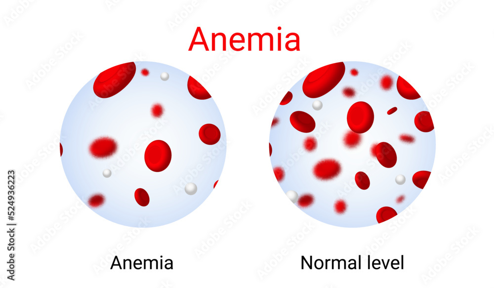 Anemia problem circulatory iron body diagram background. Anaemia ...