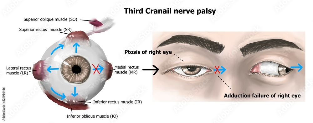 The clinical presentation of right third cranial nerve palsy. Stock ...
