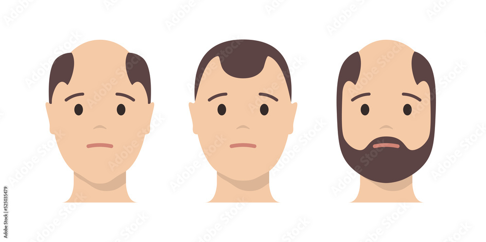 Hair loss man icon cartoon vector logo. Hair loss male scalp bald ...