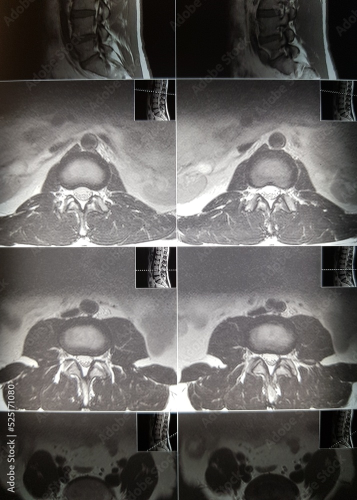 X-ray of the human spinal column Stock Photo | Adobe Stock