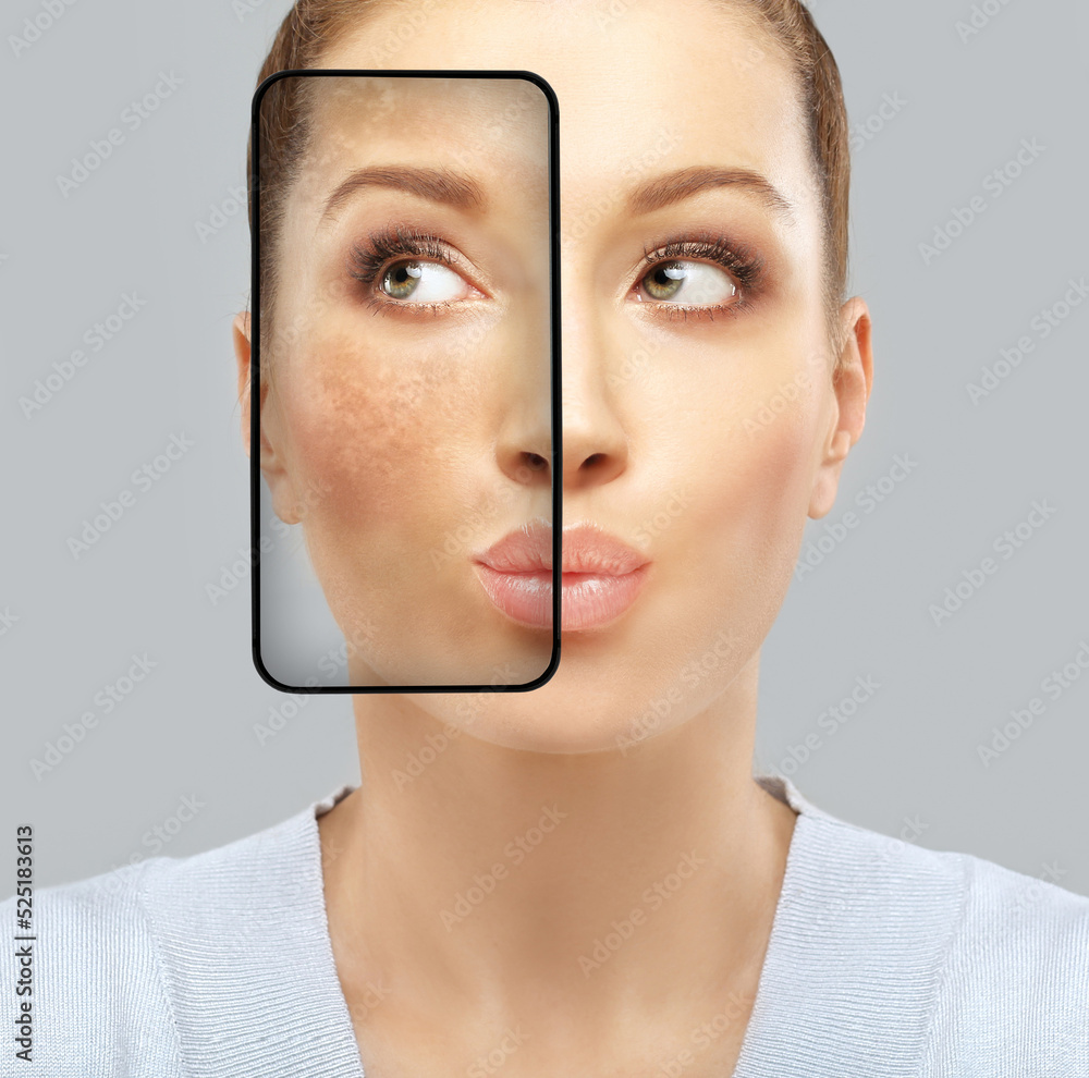 Dark spots, freckles,hyperpigmentation(melasma or chloasma),concept ...