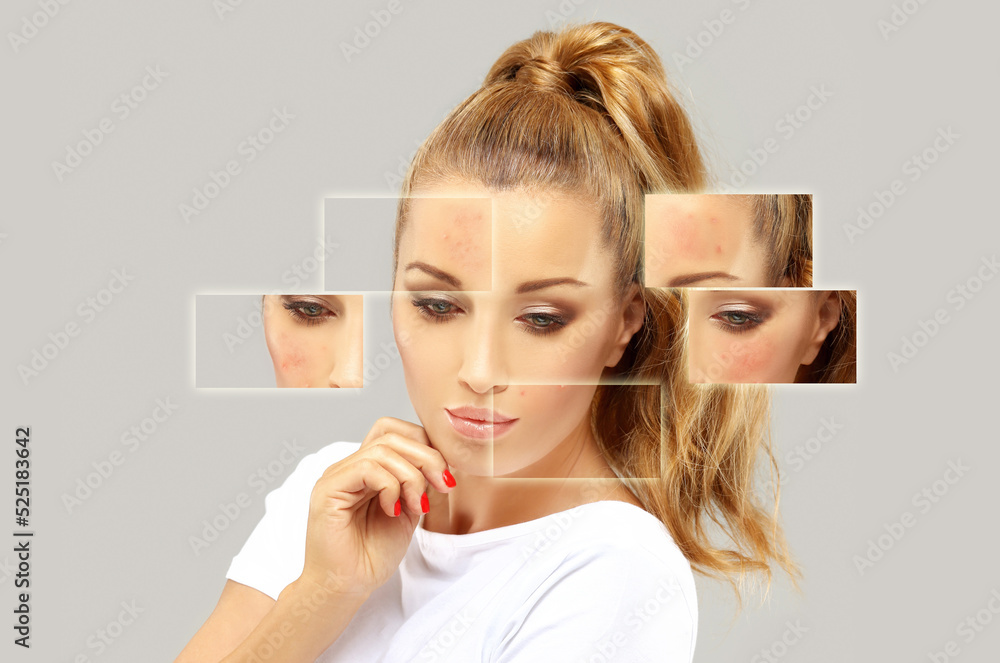 Acne,Skin concern,blemish-prone skin and acne, Rosacea,different types ...