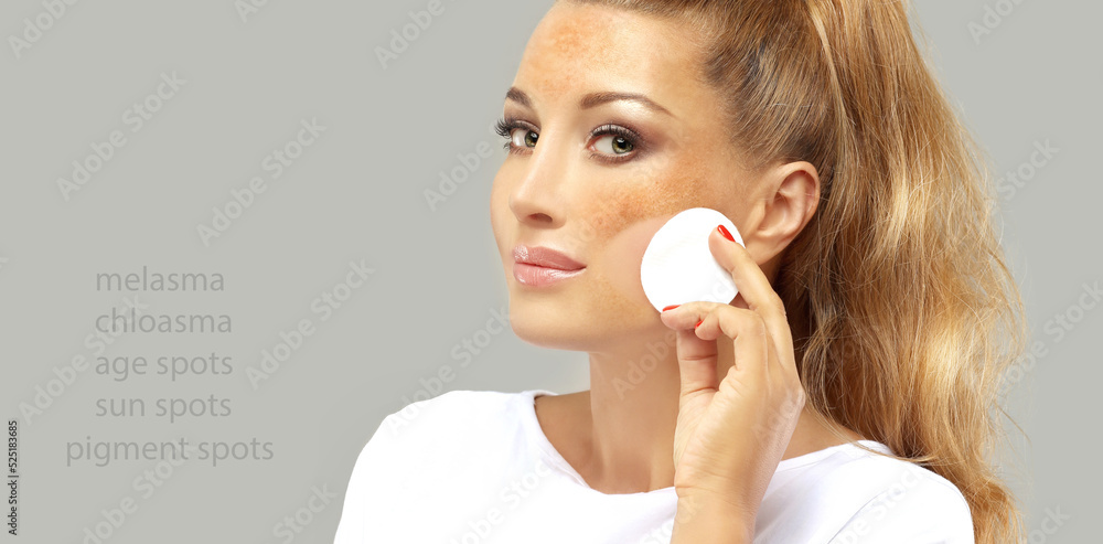 Foto de Dark spots, freckles,hyperpigmentation(melasma or chloasma ...