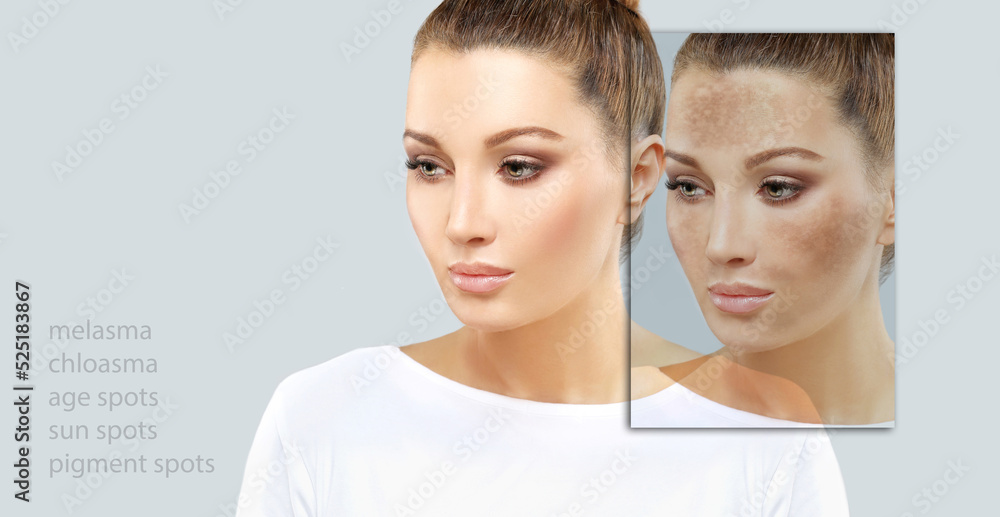 Dark spots, freckles,hyperpigmentation(melasma or chloasma),concept ...