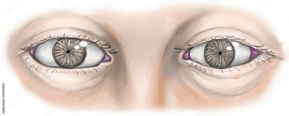 The normal diameter of pupil, the dilated pupil in midbrain lesion and ...