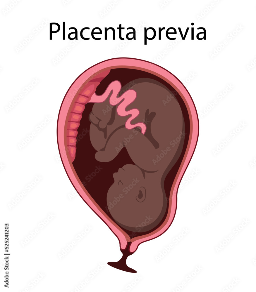 Vetor de Different Placental Locations. Fetus in Uterus During ...