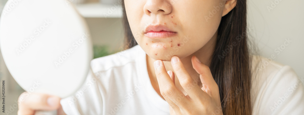 Expression worry asian young woman hand touching pustule around the ...