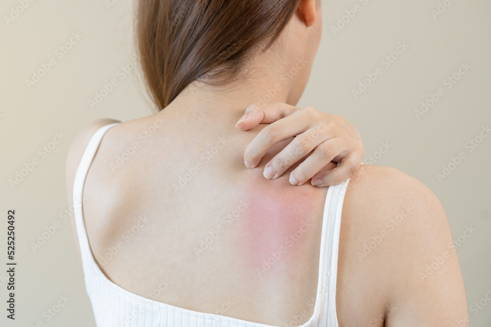 Poster Dermatology, asian young woman, girl allergy, allergic reaction ...