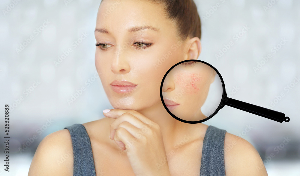Rosacea ,facial redness.Before and after. Stock Photo | Adobe Stock