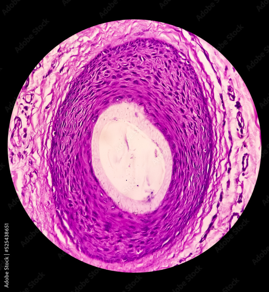 Scrotal wall(biopsy): Calcinosis cutis, show skin, subepithelial tissue ...