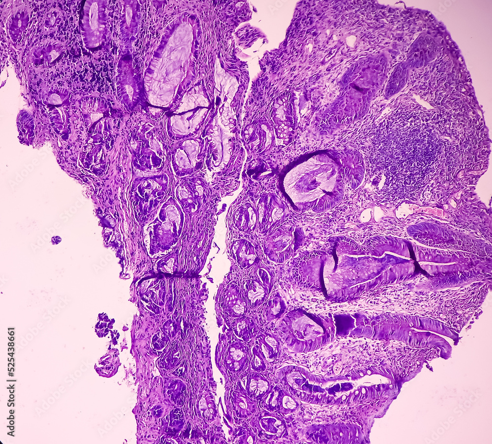 Wound area tissue: Foreign body reaction, show soft tissue, fatty ...