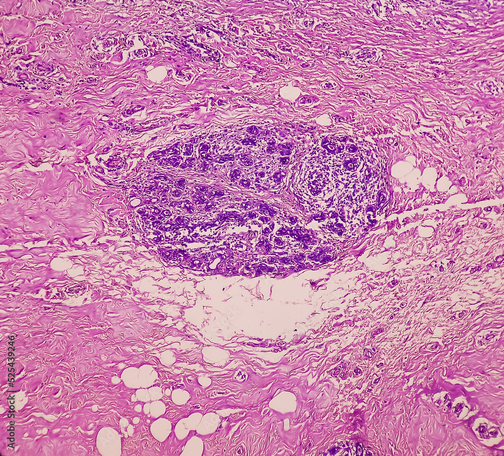 Photomicrograph of breast abscess, Granulomatous mastitis, show dense ...