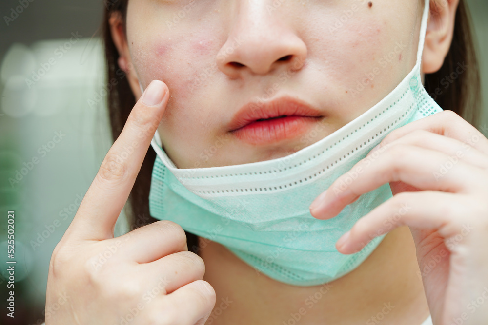 Acne pimple and scar on skin face, disorders of sebaceous glands ...