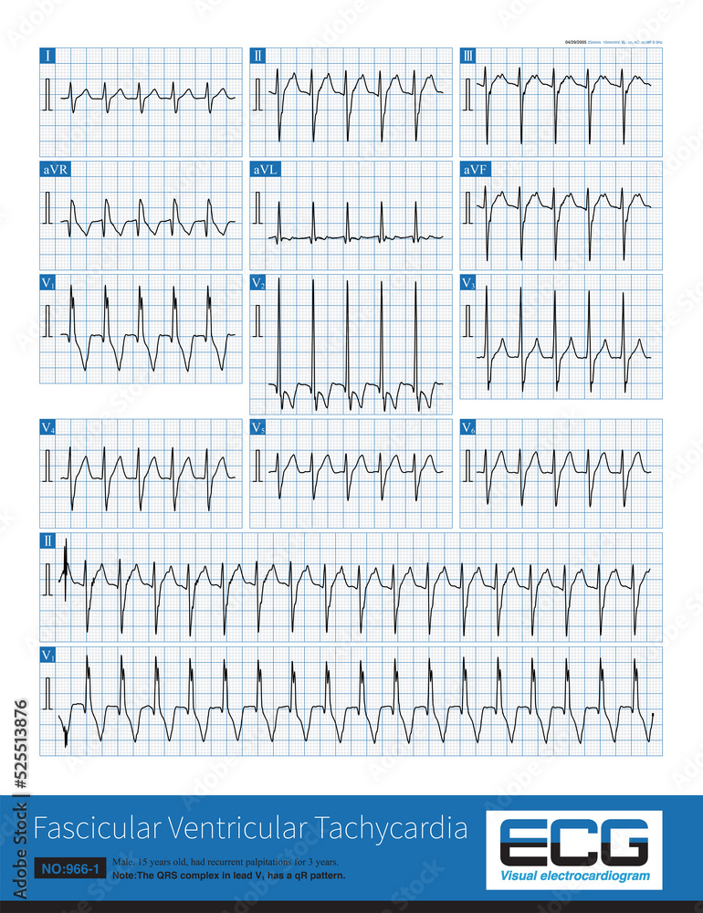 Plagát A fascicular ventricular tachycardia is an idiopathic ...