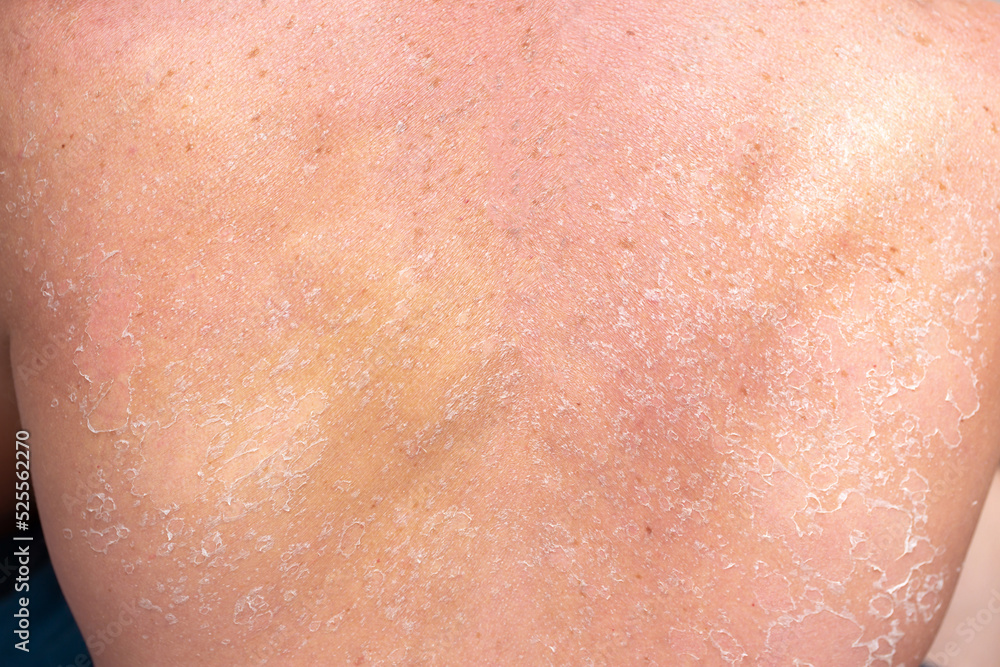 Sunburn, close-up of human skin. Flaky skin from allergies, peeling or ...