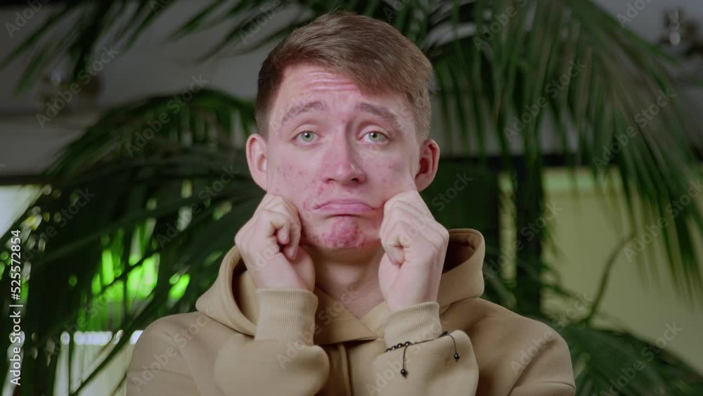 Close-up of a young man with pimples on his face. The guy is sad and ...