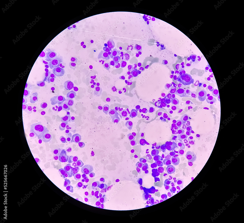 Microscopic view of bone marrow slide feature are suggestive Multiple myeloma, also known as ...