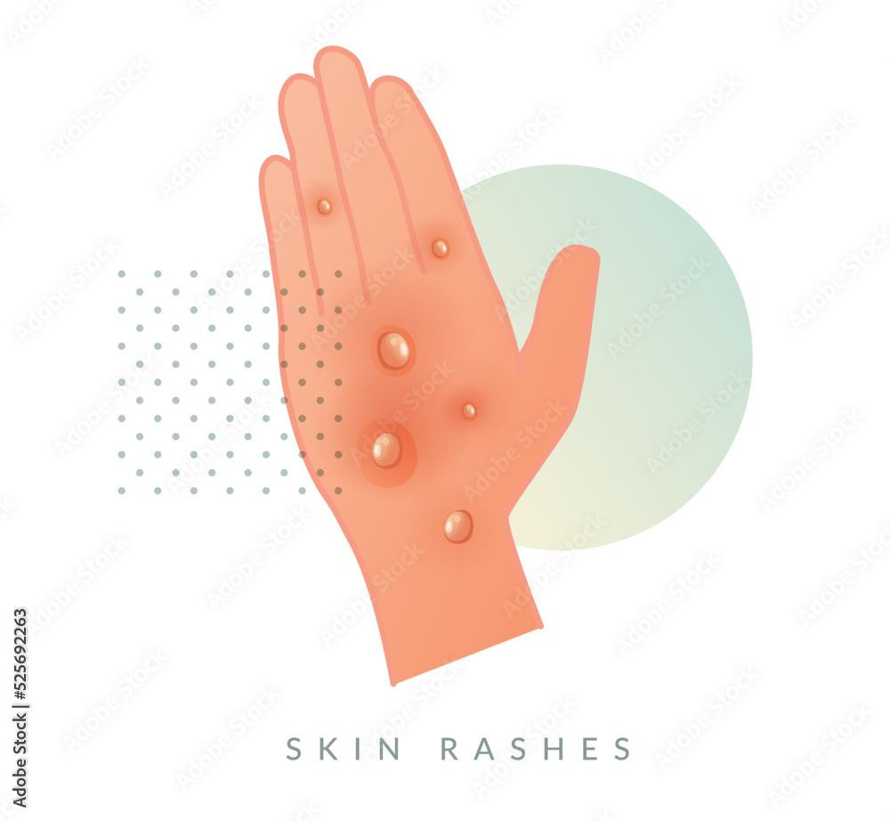 Monkeypox - Skin Rashes and Spots as Symptoms - Icon Stock Vector ...