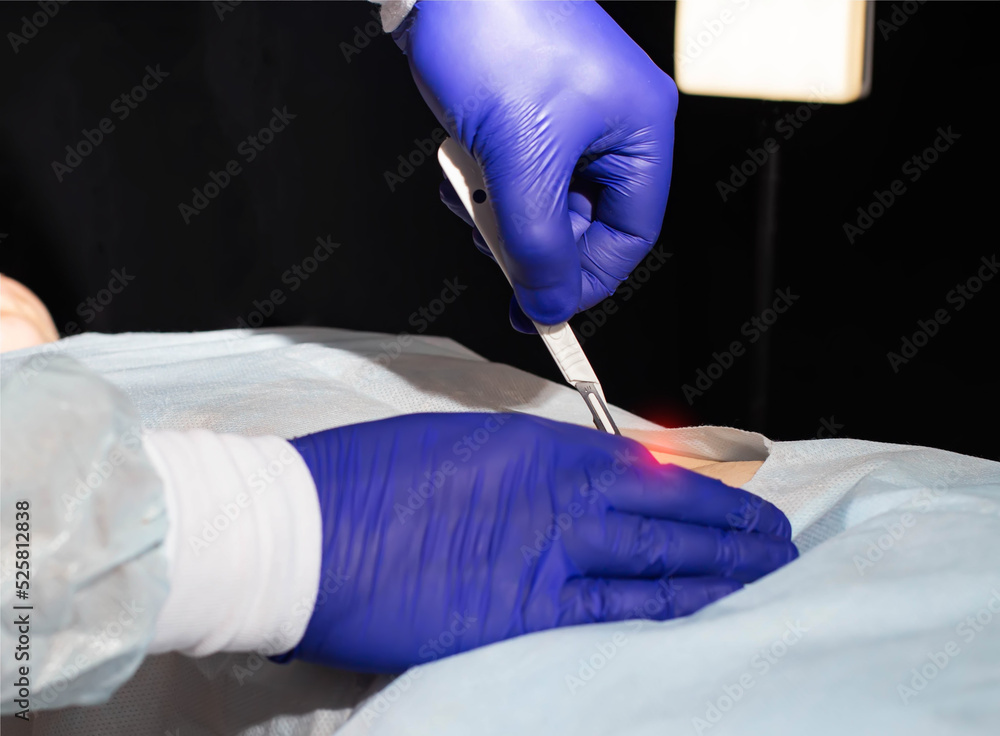 Doctor's hands in medical gloves with a scalpel in his hands. The ...