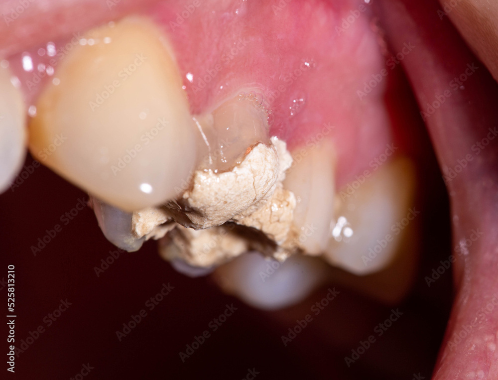 Installation of a temporary filling in the treatment of tooth canals ...