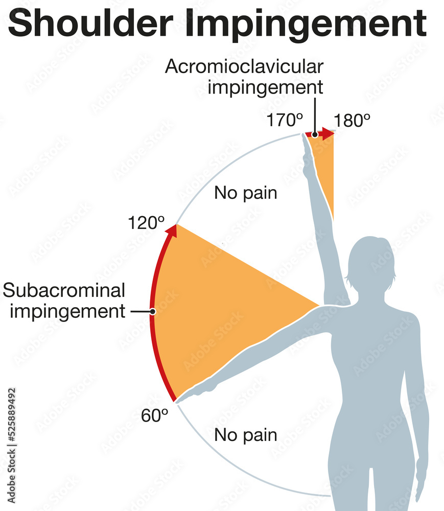 Shoulder impingement. Painful arc. Labeled Illustration Stock ... Shoulder impingement. Painful arc. Labeled Illustration Stock ...