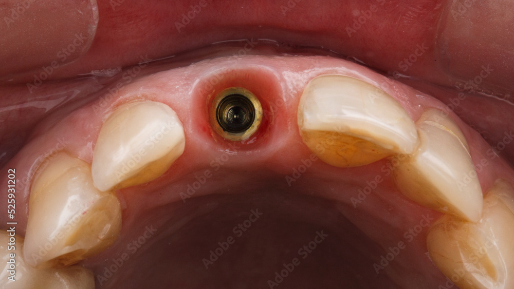 gingival cavity of the installed implant and abutment, view through the ...