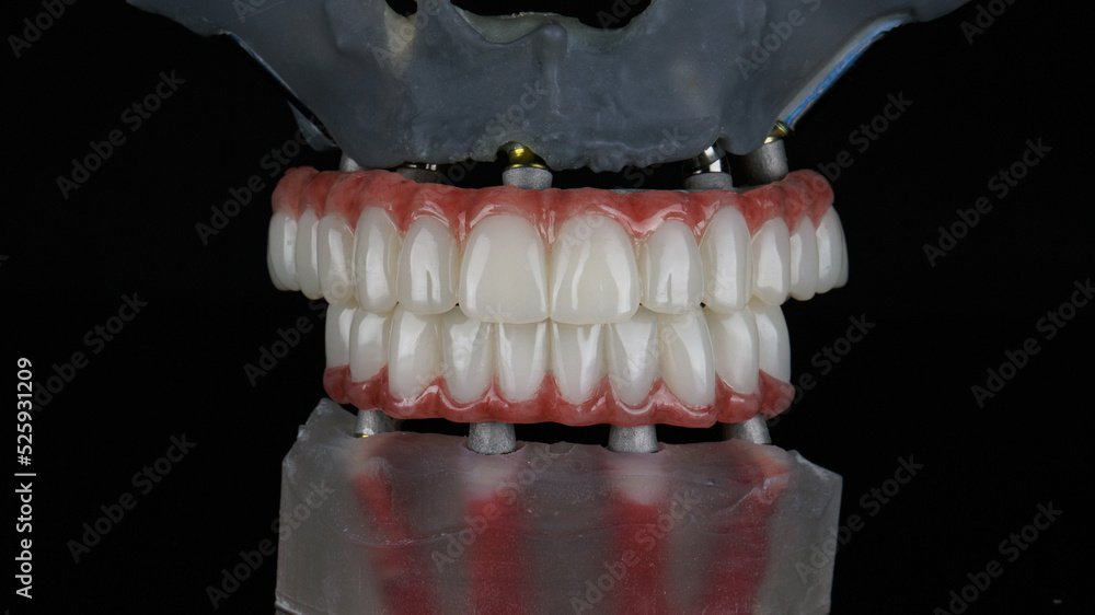 two dental prostheses in bite on beams and models on a black background ...