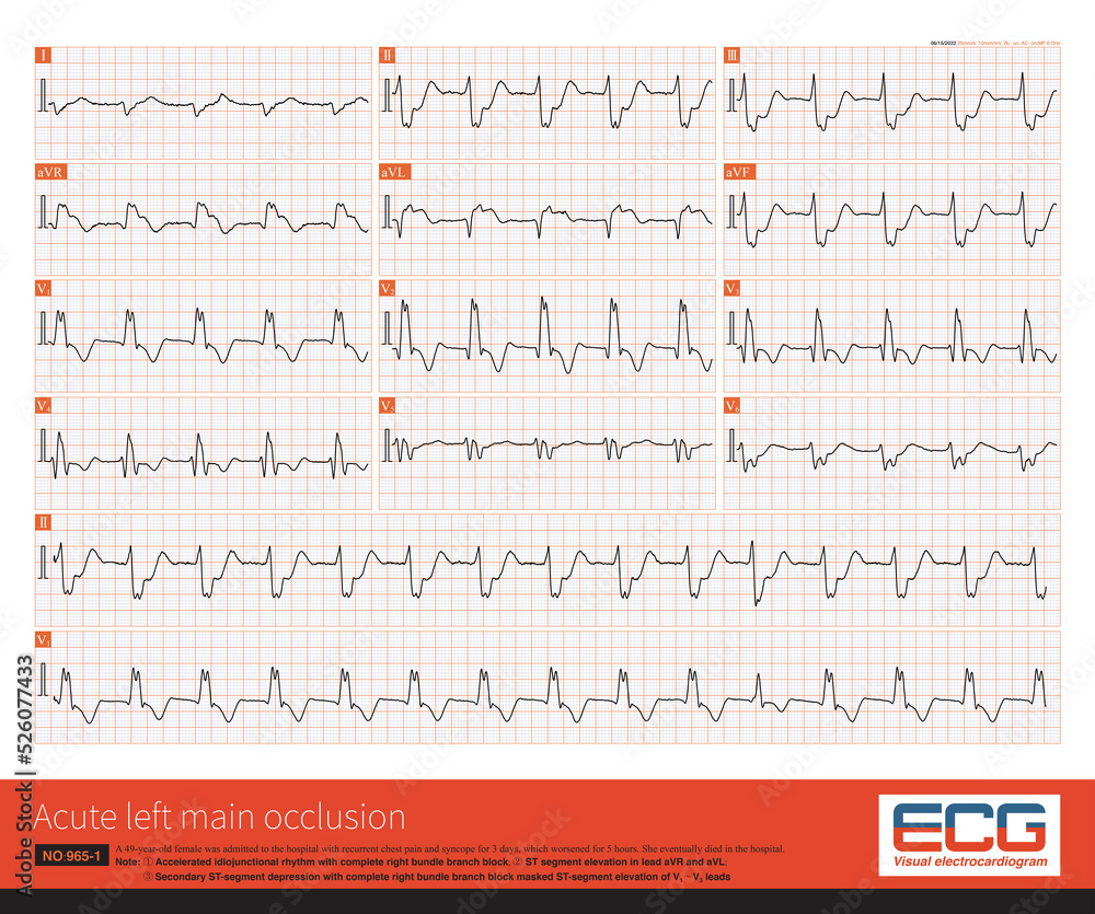 The coronary angiography showed complete occlusion of the left main ...